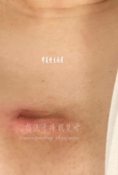 疙瘩疤痕怎么消除_疙瘩疤痕会自己消失吗-第3张图片-山城妙识