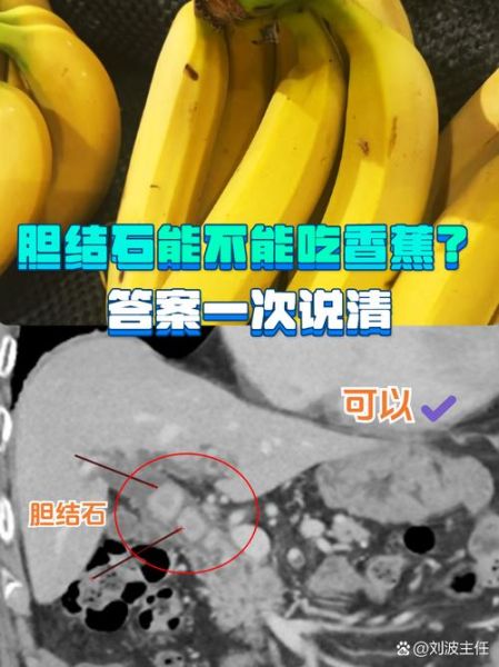 胆结石吃什么水果好_胆结石不能吃什么水果-第1张图片-山城妙识
