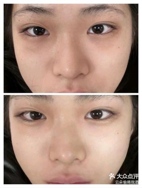 黑眼圈激光一次多少钱_效果能维持多久-第1张图片-山城妙识