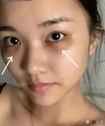 黑眼圈激光一次多少钱_效果能维持多久-第2张图片-山城妙识