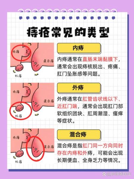 痔疮可以自愈吗_女性痔疮多久能好-第3张图片-山城妙识