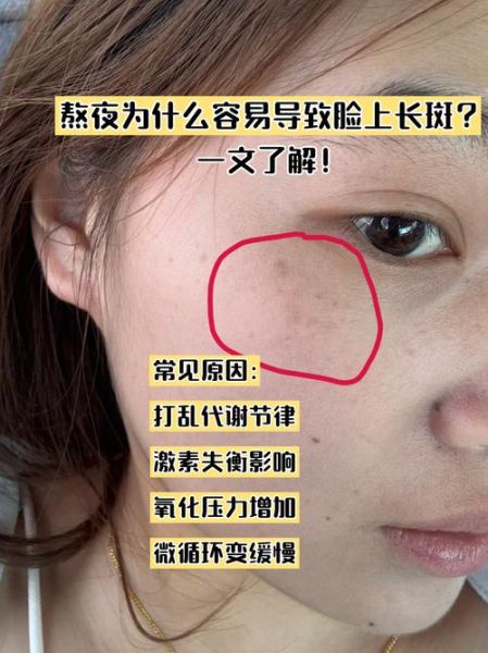 吃黑芝麻三年长斑了_黑芝麻祛斑还是致斑-第3张图片-山城妙识 吃黑芝麻三年长斑了_黑芝麻祛斑还是致斑-第3张图片-山城妙识