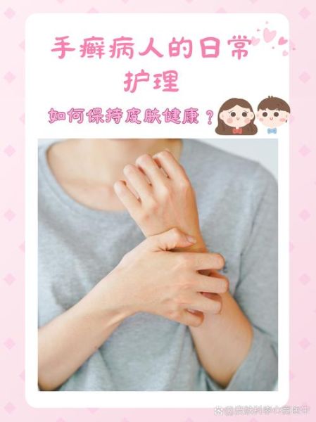 鹅掌风病怎么治疗_鹅掌风病会传染吗-第2张图片-山城妙识