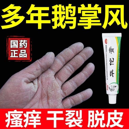 鹅掌风怎么治疗_鹅掌风用什么药膏好-第1张图片-山城妙识
