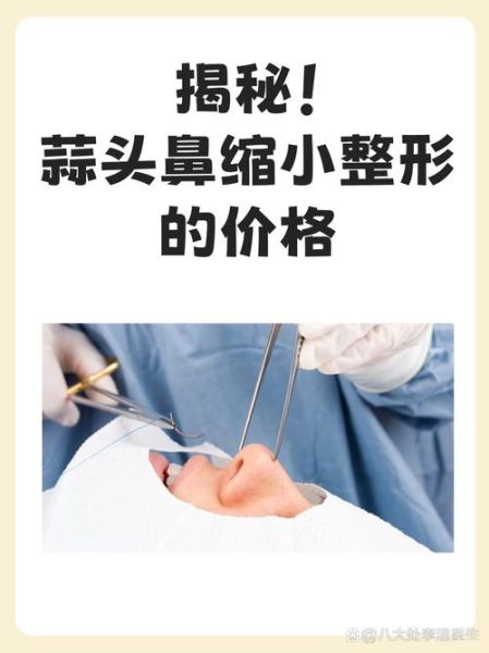 蒜头鼻整形价格_蒜头鼻整形多少钱-第1张图片-山城妙识