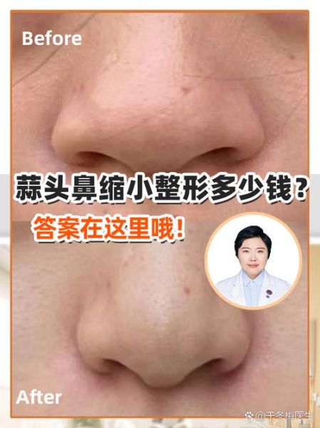 蒜头鼻整形价格_蒜头鼻整形多少钱-第2张图片-山城妙识