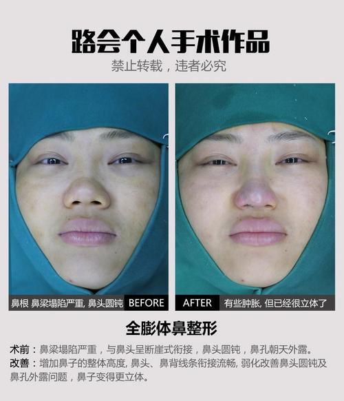 蒜头鼻整形价格_蒜头鼻整形多少钱-第3张图片-山城妙识