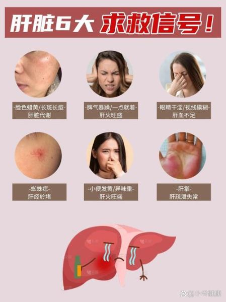 肝病早期有哪些症状_肝病七个征兆是什么-第2张图片-山城妙识 肝病早期有哪些症状_肝病七个征兆是什么-第2张图片-山城妙识