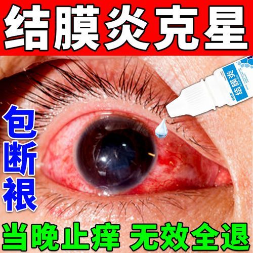 过敏性结膜炎多久能好_过敏性结膜炎几天能痊愈-第2张图片-山城妙识 过敏性结膜炎多久能好_过敏性结膜炎几天能痊愈-第2张图片-山城妙识