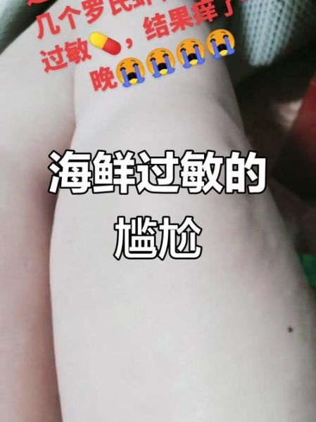 吃虾全身痒怎么办_吃虾过敏全身痒的应急处理-第3张图片-山城妙识 吃虾全身痒怎么办_吃虾过敏全身痒的应急处理-第3张图片-山城妙识