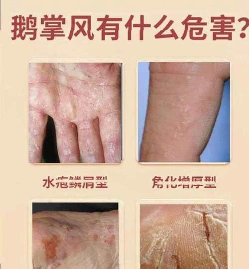 鹅掌风图片_根治特效方法-第3张图片-山城妙识 鹅掌风图片_根治特效方法-第3张图片-山城妙识
