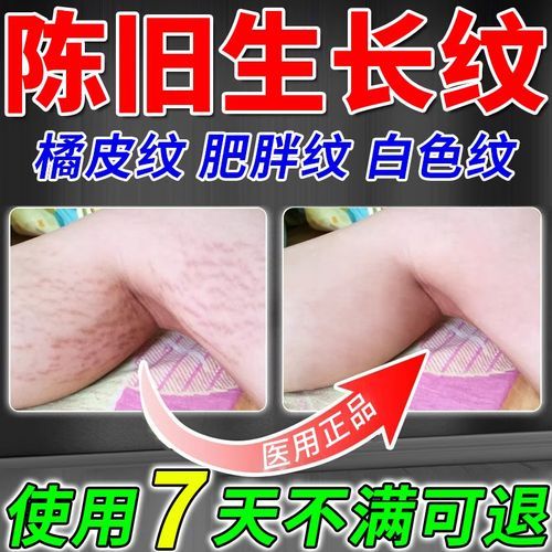 橘皮纹怎么消除_橘皮纹是什么原因-第1张图片-山城妙识 橘皮纹怎么消除_橘皮纹是什么原因-第1张图片-山城妙识