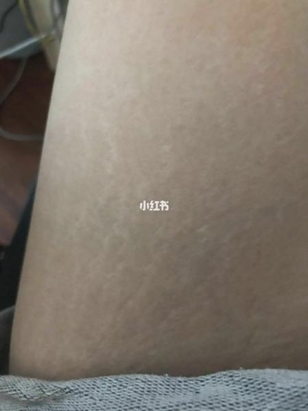 橘皮纹怎么消除_橘皮纹是什么原因-第3张图片-山城妙识 橘皮纹怎么消除_橘皮纹是什么原因-第3张图片-山城妙识