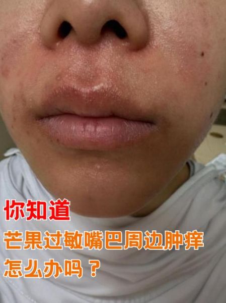 芒果过敏嘴唇长小颗粒怎么办_多久能好-第1张图片-山城妙识 芒果过敏嘴唇长小颗粒怎么办_多久能好-第1张图片-山城妙识