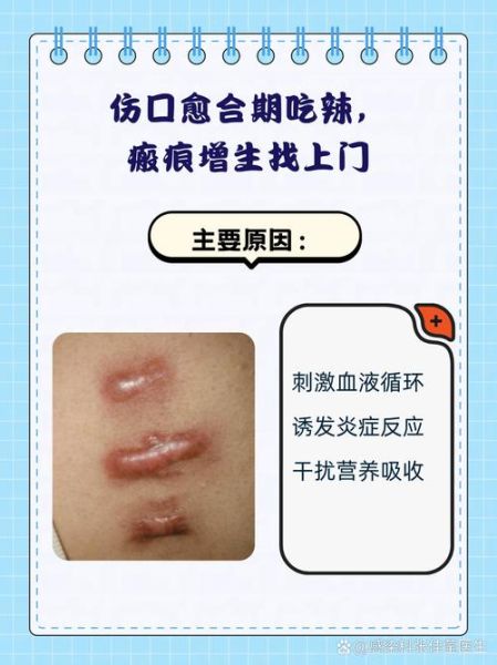 辣椒素会烧伤皮肤吗_辣椒素对皮肤伤害程度-第3张图片-山城妙识 辣椒素会烧伤皮肤吗_辣椒素对皮肤伤害程度-第3张图片-山城妙识