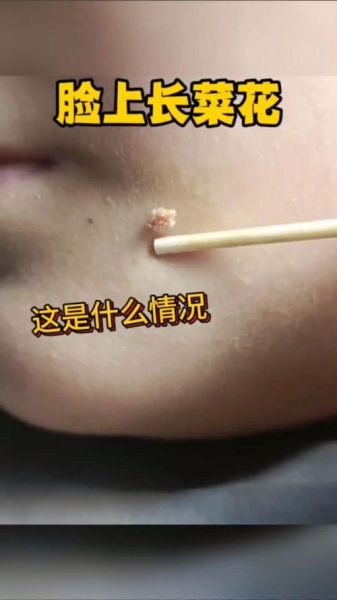长菜花是什么病_长菜花初期症状有哪些-第1张图片-山城妙识 长菜花是什么病_长菜花初期症状有哪些-第1张图片-山城妙识