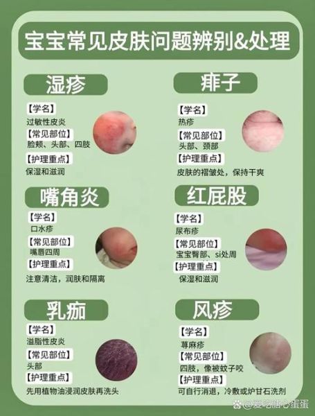 过敏和湿疹的区别_如何判断是过敏还是湿疹-第3张图片-山城妙识 过敏和湿疹的区别_如何判断是过敏还是湿疹-第3张图片-山城妙识