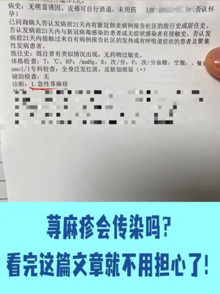荨麻疹是肝癌的前兆吗_荨麻疹和肝癌的关系-第3张图片-山城妙识 荨麻疹是肝癌的前兆吗_荨麻疹和肝癌的关系-第3张图片-山城妙识