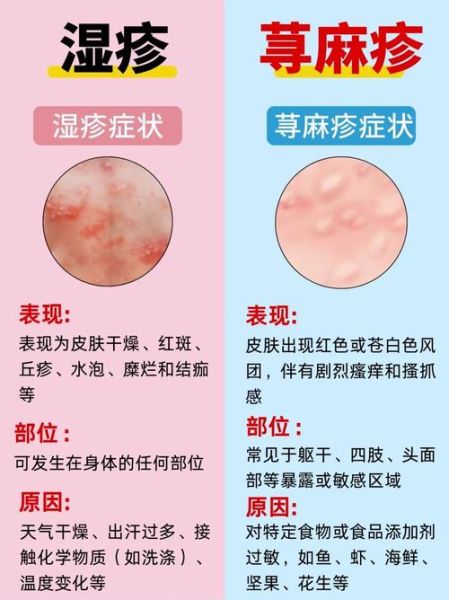 过敏性荨麻疹图片_如何辨别风团与湿疹-第1张图片-山城妙识 过敏性荨麻疹图片_如何辨别风团与湿疹-第1张图片-山城妙识