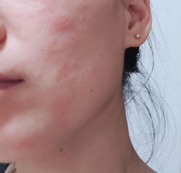 芒果过敏脸肿会自愈吗_多久能消肿-第2张图片-山城妙识 芒果过敏脸肿会自愈吗_多久能消肿-第2张图片-山城妙识