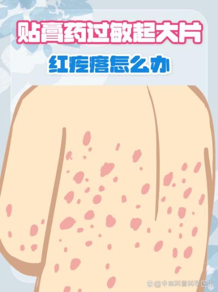 过敏症状有哪些表现_过敏症状怎么缓解-第2张图片-山城妙识 过敏症状有哪些表现_过敏症状怎么缓解-第2张图片-山城妙识