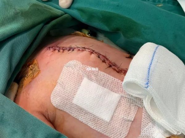 儿童鸡胸的症状有哪些_鸡胸图片怎么看-第3张图片-山城妙识 儿童鸡胸的症状有哪些_鸡胸图片怎么看-第3张图片-山城妙识