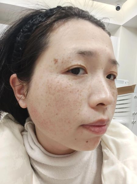 雀斑是怎么形成的_雀斑怎么淡化最有效-第2张图片-山城妙识