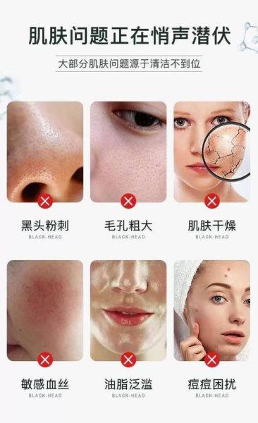 脸上皮肤毒素垃圾怎么排出来_脸上毒素垃圾排出方法-第2张图片-山城妙识