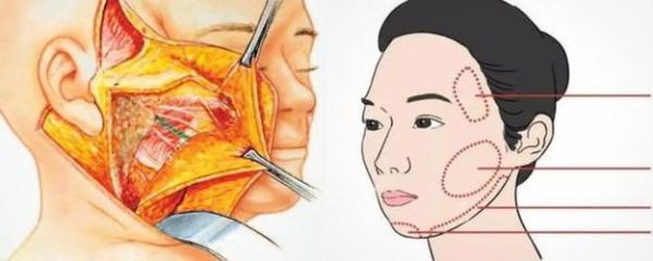 美容拉皮是怎么做的_拉皮手术全过程-第2张图片-山城妙识
