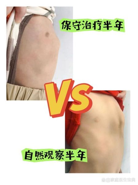 鸡胸宝宝平躺图片_鸡胸宝宝平躺睡觉正常吗-第2张图片-山城妙识 鸡胸宝宝平躺图片_鸡胸宝宝平躺睡觉正常吗-第2张图片-山城妙识