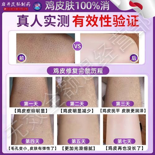 鸡皮肤怎么治疗_鸡皮肤用什么药膏最有效-第2张图片-山城妙识