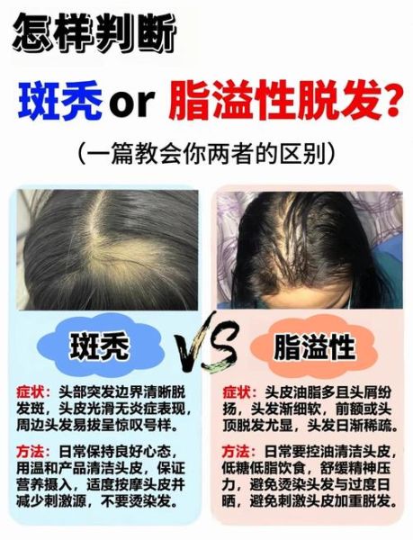 脂溢性脱发早期图片_怎么判断-第1张图片-山城妙识 脂溢性脱发早期图片_怎么判断-第1张图片-山城妙识