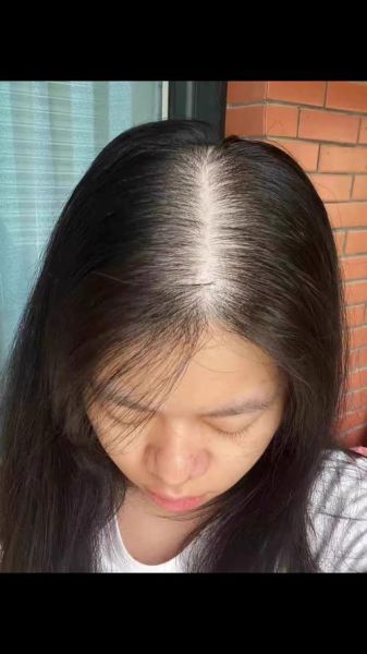 脂溢性脱发早期图片_怎么判断-第2张图片-山城妙识 脂溢性脱发早期图片_怎么判断-第2张图片-山城妙识