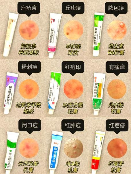 祛痘最好的药膏有哪些_怎么选-第1张图片-山城妙识 祛痘最好的药膏有哪些_怎么选-第1张图片-山城妙识
