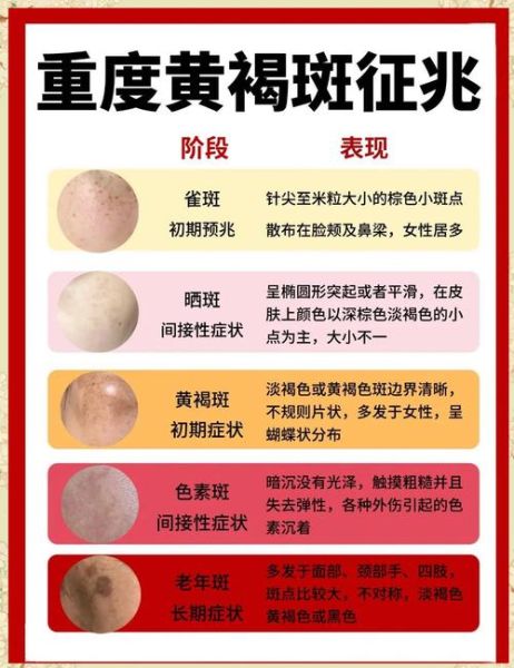 脸上长斑怎么办_有哪些土方法-第1张图片-山城妙识 脸上长斑怎么办_有哪些土方法-第1张图片-山城妙识