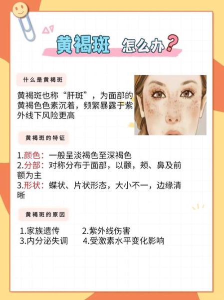 雀斑能去掉吗_雀斑怎么彻底去除-第1张图片-山城妙识