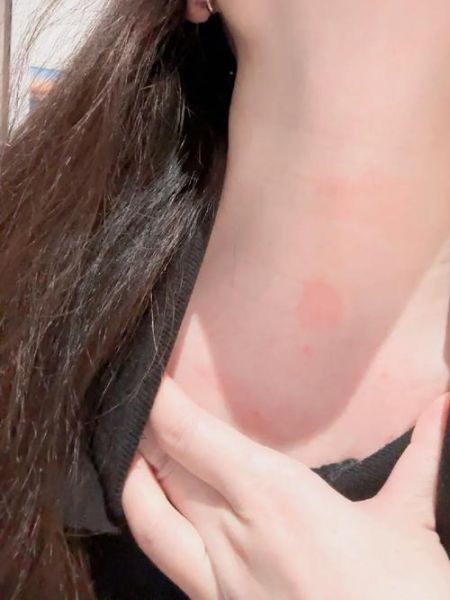 蚕豆病皮肤症状图片_如何识别典型皮疹-第1张图片-山城妙识