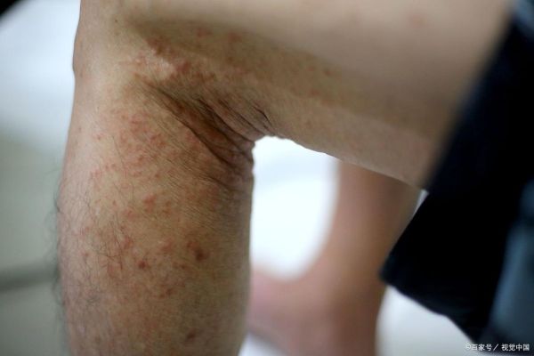 蚕豆病皮肤症状图片_如何识别典型皮疹-第3张图片-山城妙识