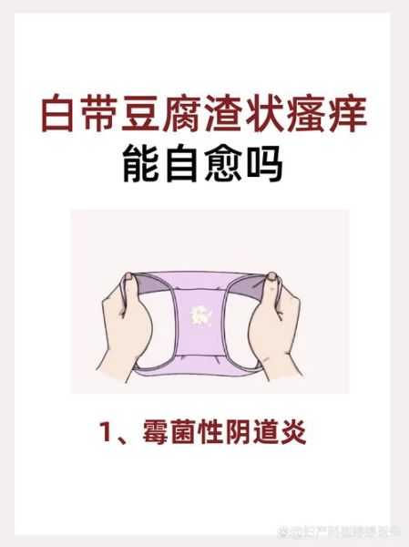 白带像豆腐渣会得癌吗_白带豆腐渣样是癌症吗-第1张图片-山城妙识