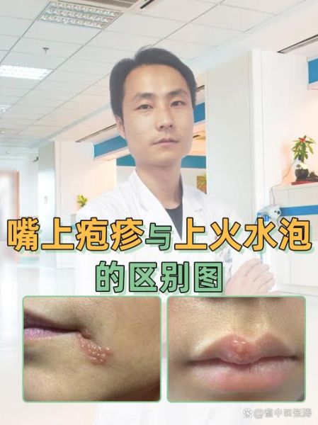 一夜之间嘴唇上起泡是什么原因_嘴唇起泡怎么办-第3张图片-山城妙识 一夜之间嘴唇上起泡是什么原因_嘴唇起泡怎么办-第3张图片-山城妙识