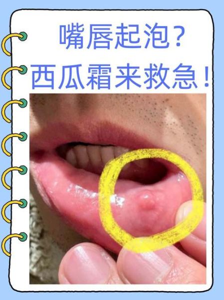 一夜之间嘴唇上起泡是什么原因_嘴唇起泡怎么办-第1张图片-山城妙识 一夜之间嘴唇上起泡是什么原因_嘴唇起泡怎么办-第1张图片-山城妙识
