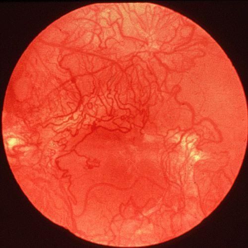 脉络膜新生血管能治好吗_如何预防复发-第2张图片-山城妙识 脉络膜新生血管能治好吗_如何预防复发-第2张图片-山城妙识