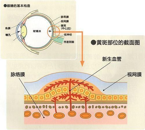 脉络膜新生血管能治好吗_如何预防复发-第3张图片-山城妙识 脉络膜新生血管能治好吗_如何预防复发-第3张图片-山城妙识