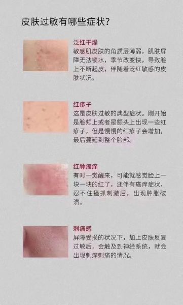 过敏症状一般持续几天_多久能彻底好-第1张图片-山城妙识 过敏症状一般持续几天_多久能彻底好-第1张图片-山城妙识