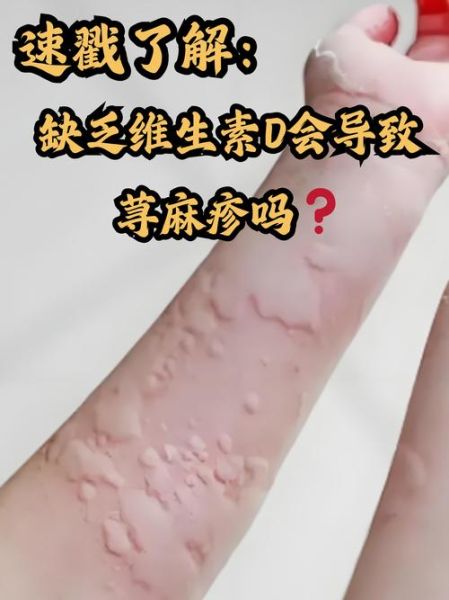 过敏症状一般持续几天_多久能彻底好-第2张图片-山城妙识 过敏症状一般持续几天_多久能彻底好-第2张图片-山城妙识