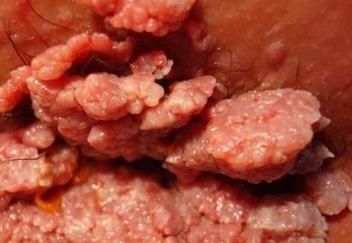 菜花状疣图片女性_早期症状有哪些-第2张图片-山城妙识 菜花状疣图片女性_早期症状有哪些-第2张图片-山城妙识