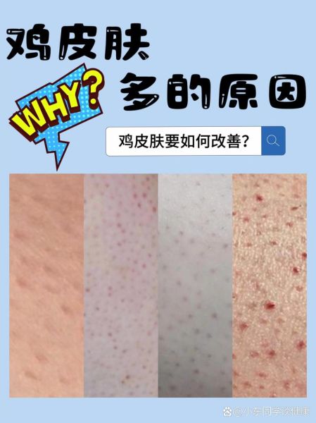 鸡皮肤会自己消失吗_鸡皮肤多久能好-第2张图片-山城妙识 鸡皮肤会自己消失吗_鸡皮肤多久能好-第2张图片-山城妙识