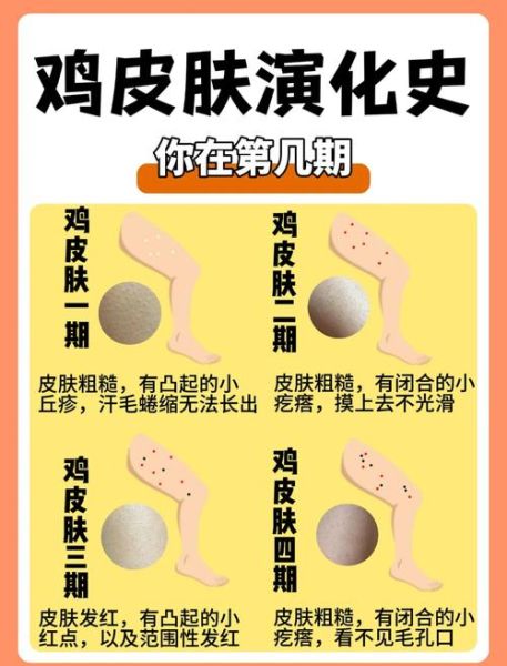 鸡皮肤会自己消失吗_鸡皮肤多久能好-第3张图片-山城妙识 鸡皮肤会自己消失吗_鸡皮肤多久能好-第3张图片-山城妙识