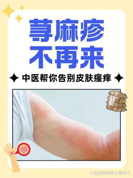 荨麻疹最怕三样东西_荨麻疹怎么快速止痒-第1张图片-山城妙识