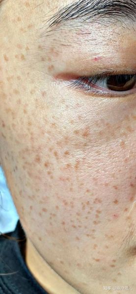 麻子是什么意思_麻子脸怎么来的-第1张图片-山城妙识 麻子是什么意思_麻子脸怎么来的-第1张图片-山城妙识